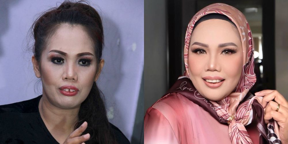 15 Transformasi Artis Sebelum Dan Sesudah Suntik Botoks Ada Yang