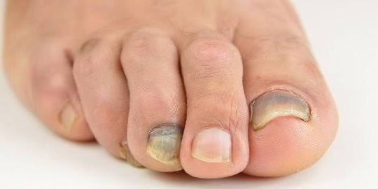 Cara Mengatasi Kuku Kuning karena Infeksi Jamur, Tidak Perlu dengan ...