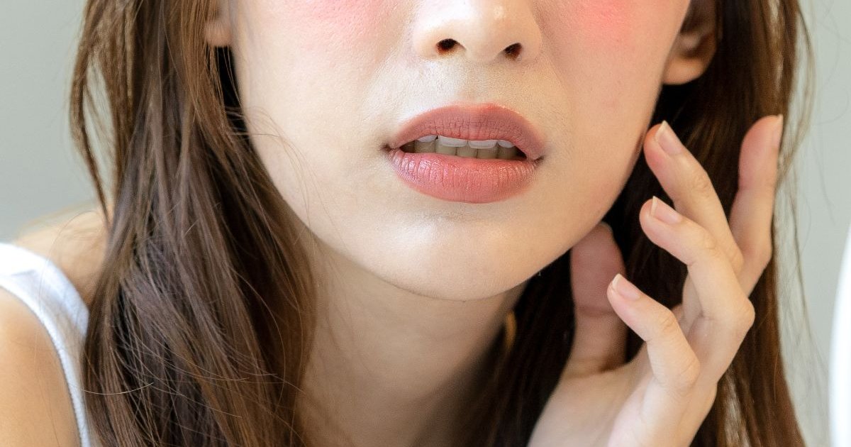 Pakai Acne Patch Terlalu Lama Bisa Bikin Iritasi, Simak Penjelasan Dokter