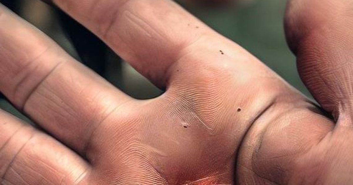 Bisa Masuk Tubuh Manusia Melalui 4 Cara, Ketahui Gejala Terinfeksi ...
