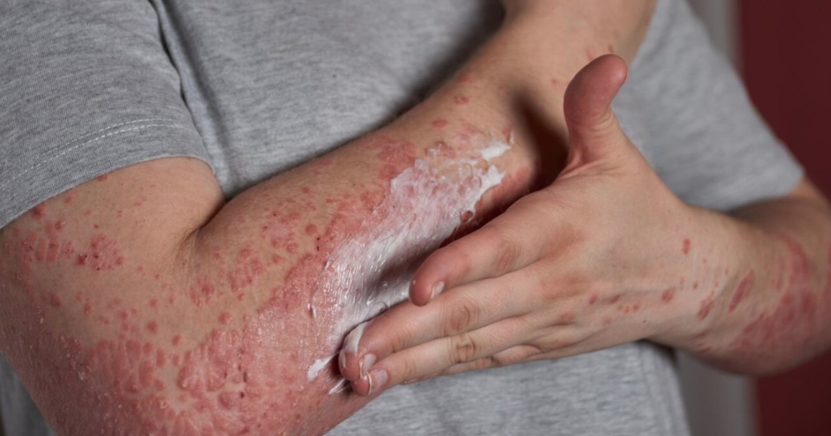Mengenal Steven Johnson Syndrome: Gejala Awal, Penyebab, Komplikasi ...