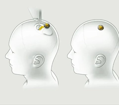 Neuralink Company Wants Volunteer For Its Brain Implant Chip | trstdly ...