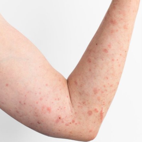 Kenali Kondisi Ruam yang Kerap Muncul pada Pasien Mpox - merdeka.com