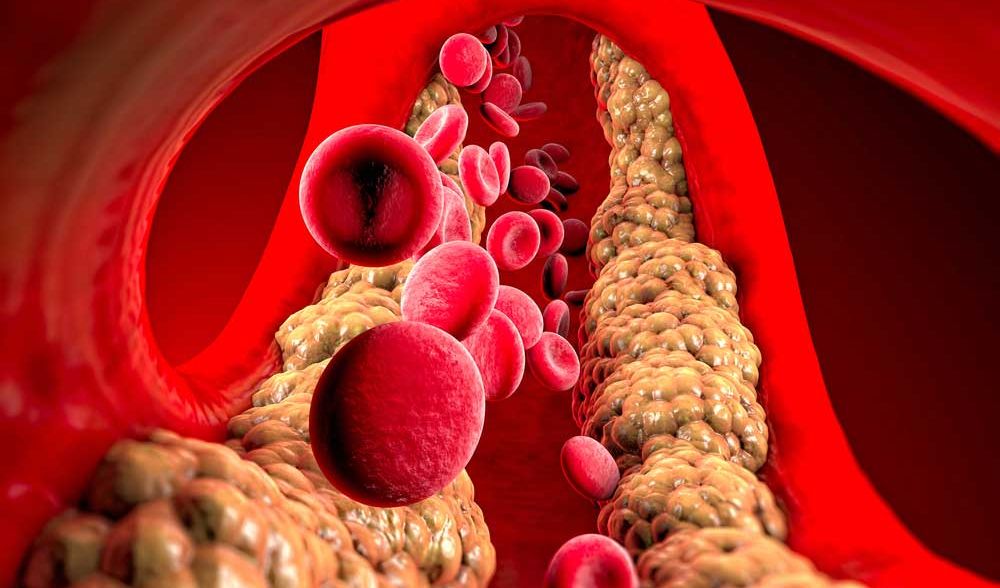 Mengenal Ciri-ciri Trigliserida Tinggi dan Penyebabnya, Bantu Deteksi ...