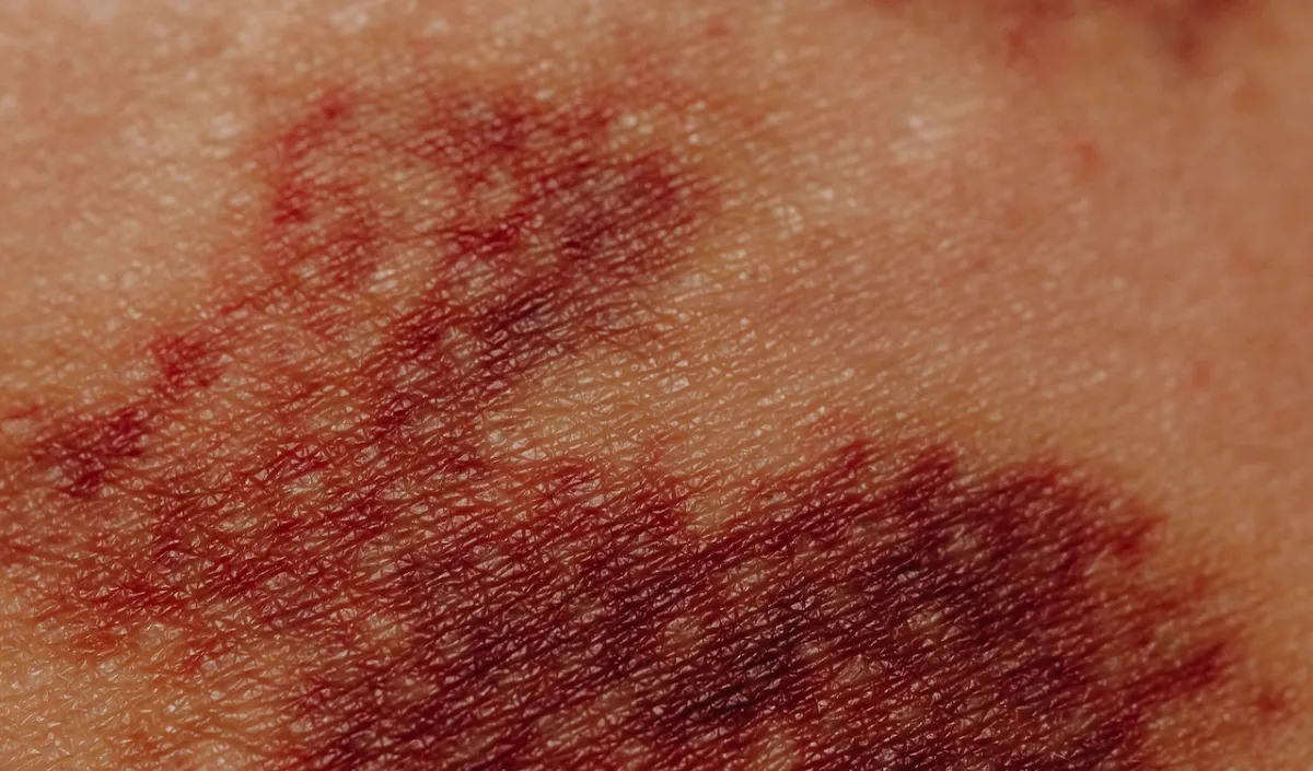 Muncul Lebam Secara Tiba-Tiba di Kulit, 7 Hal Ini Bisa Jadi Penyebabnya ...