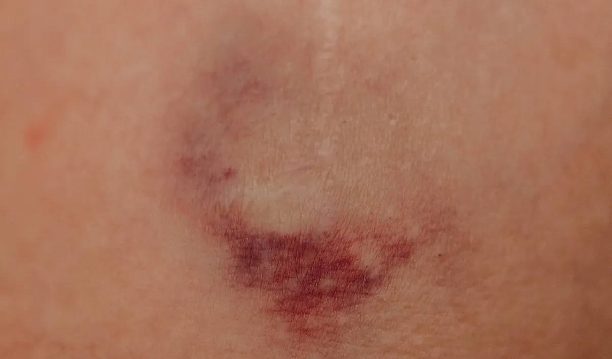 Muncul Lebam Secara Tiba-Tiba di Kulit, 7 Hal Ini Bisa Jadi Penyebabnya ...