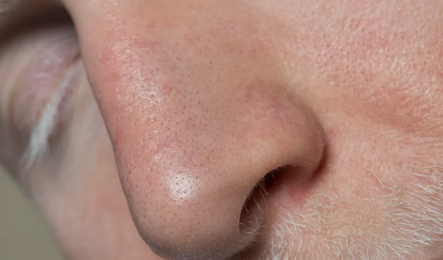 Beda Komedo Putih dan Komedo Hitam, Penyebab, Jenis, dan Cara Mengatasinya