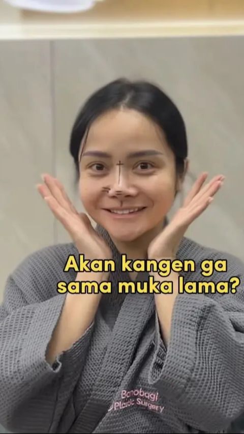 Mawar AFI Oplas Hidung Lagi Implan Pakai Tulang Iga, Ini Potretnya ...