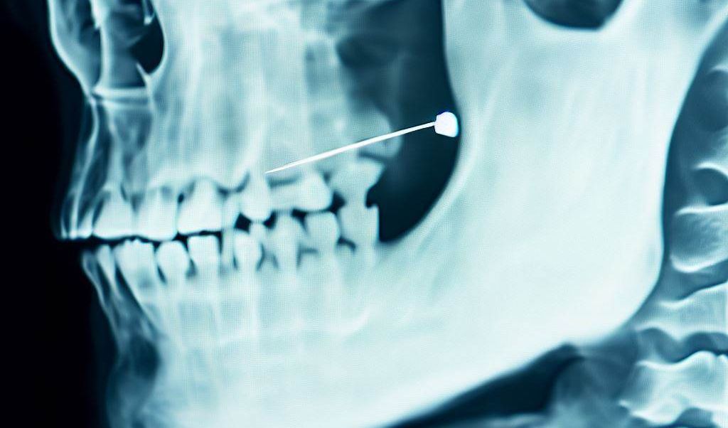 Penyebab Mengapa Susuk Bisa Terlihat saat Dilakukan Pemeriksaan Radiografi