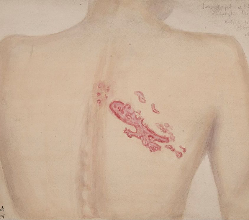 10 Cara Mudah dan Praktis Mencegah Luka Berubah Menjadi Keloid