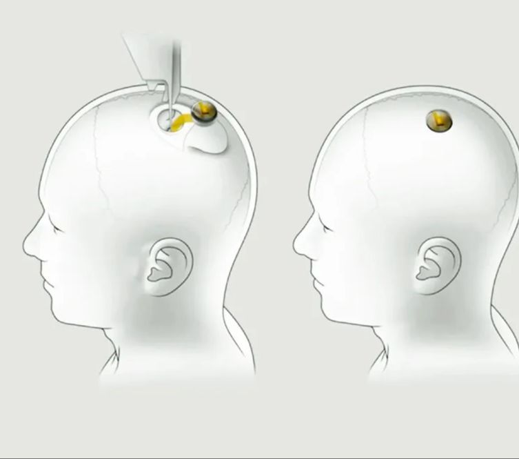 Neuralink Company Wants Volunteer For Its Brain Implant Chip | trstdly ...