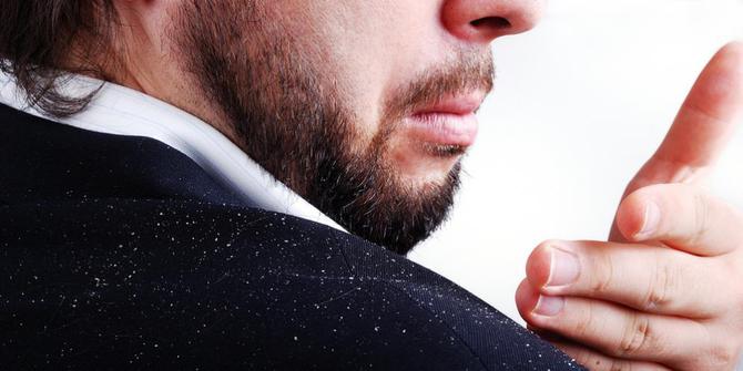 Mengenal apa itu ketombe | merdeka.com