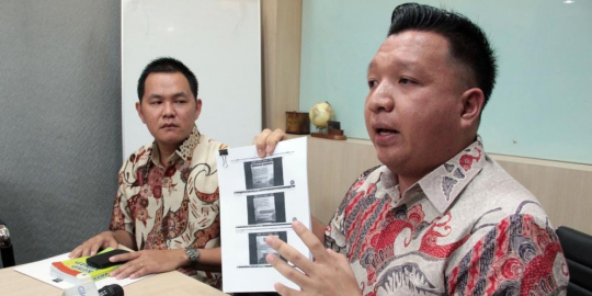 6 Cerita menyedihkan mahasiswi Binus korban penyiraman air keras ...