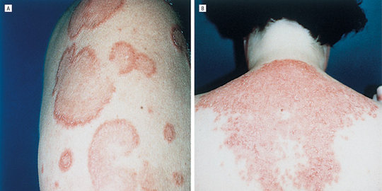 Yuk, kenali 5 jenis penyakit lupus ini! | merdeka.com