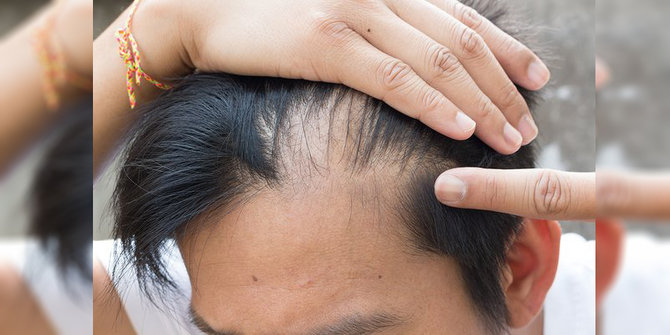 Tips ampuh cegah dan atasi kebotakan bagi pria secara alami | merdeka.com