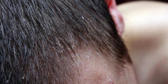 7 Fakta mencengangkan tentang ketombe yang jarang diketahui | merdeka.com