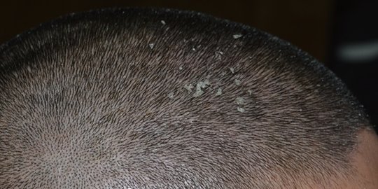 7 Fakta mencengangkan tentang ketombe yang jarang diketahui | merdeka.com