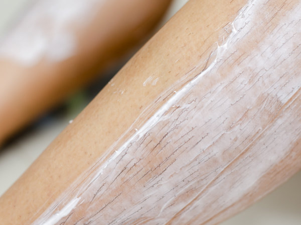 Gejala Penyakit Panu, Ketahui Penyebab dan Cara Mengatasinya | merdeka.com