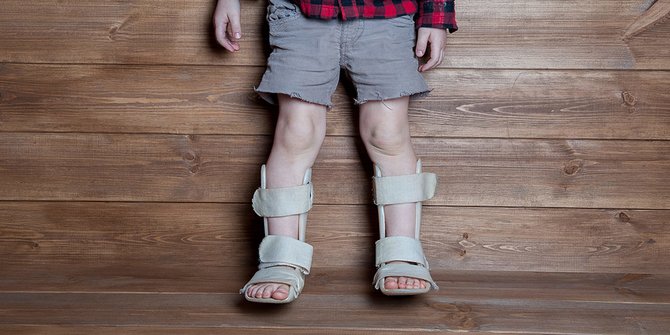 Penyebab Rakitis beserta Gejala dan Cara Pengobatannya, Awasi Anak Anda ...