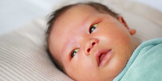 Penyebab Penyakit Kuning pada Bayi, Ketahui Gejala dan Cara Mencegahnya | merdeka.com