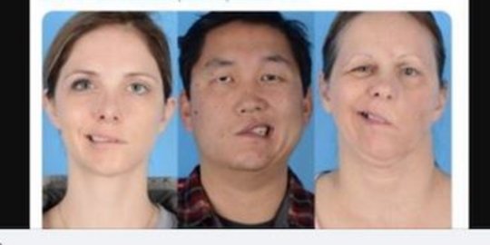 CEK FAKTA: Ini Bukan Foto Relawan yang Alami Bell's Palsy Akibat Vaksin ...