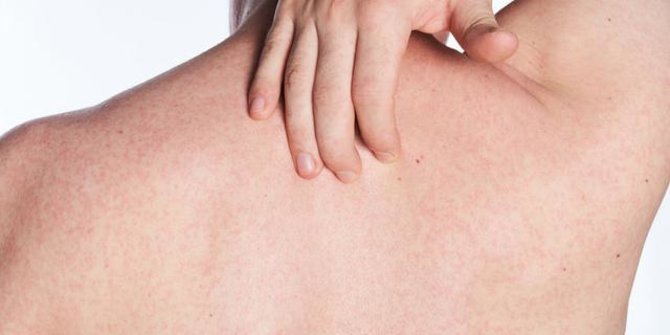 Ciri-Ciri Panu yang Perlu Diketahui, Pahami Cara Mengobati dan ...