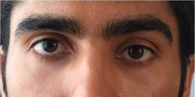 Penyebab Mata Juling yang Perlu Diwaspadai, Ketahui Gejala dan Cara ...