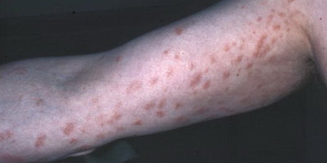 Parapsoriasis adalah Kondisi Kulit Merah dan Bersisik, Kenali Gejala ...