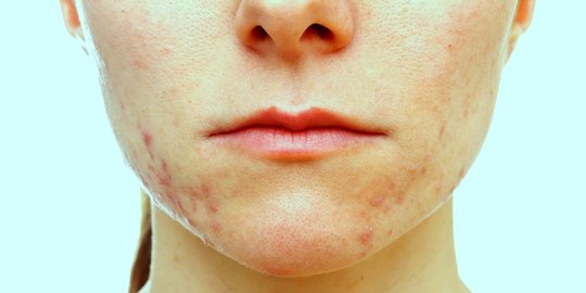 Penyebab Jerawat Batu yang Perlu Diwaspadai, Ketahui Ciri-Ciri dan Cara Mengatasinya | merdeka.com