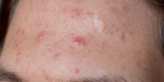 Penyebab Jerawat Batu dan Cara Mengatasinya, Aman dan Mudah Dilakukan | merdeka.com