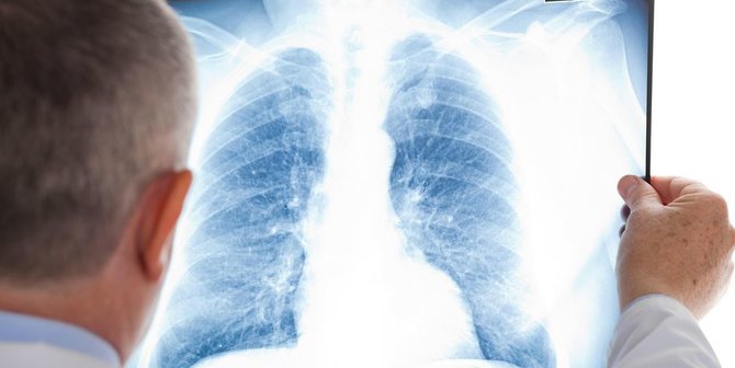 Kenali Penyakit Paru Obstruktif Kronis Beserta Ciri dan Gejala yang ...