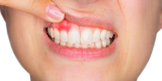 Periodontitis adalah Infeksi Gusi yang Dapat Merusak Gigi, Kenali ...