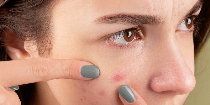 Kenali Ciri-ciri Purging! Ini Beberapa Perbedaannya dengan Breakout | merdeka.com