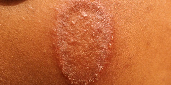 Gejala dan Penyebab Ringworm, Infeksi Jamur Kucing yang Menyerang ...