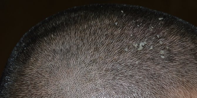 Penyebab Tinea Capitis, Infeksi Jamur pada Kulit Kepala, Gejala, dan ...