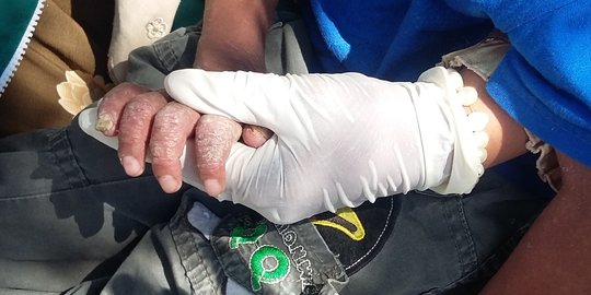 Mengenal Ichthyosis, Kelainan Kulit yang Lebih Tipis dari Orang Normal ...