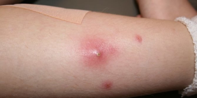 Cara Mengobati Bisul dengan Bahan Alami, Efektif dan Mudah Dilakukan ...