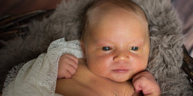 Kenali Sedari Dini, Ini Gejala Kuning Pada Bayi yang Dianggap Berbahaya | merdeka.com