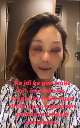 Jadi Sorotan, Begini Potret Terbaru Bunda Corla Usai Buka Perban ...