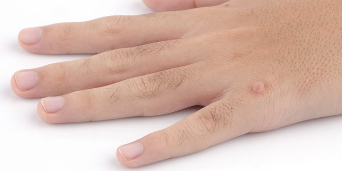 Penyebab Kutil Tumbuh yang Penting untuk Diketahui, Simak Cara ...