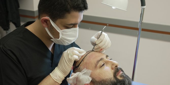 5 Efek Samping Transplantasi Rambut yang Perlu Diketahui | merdeka.com