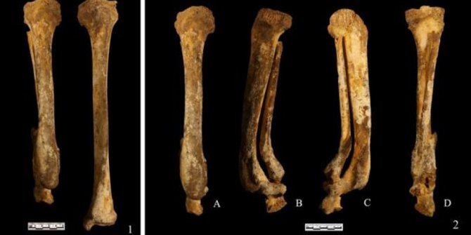 Amputasi Tertua di Dunia Terjadi 3000 Tahun Lalu, Ternyata Ini ...
