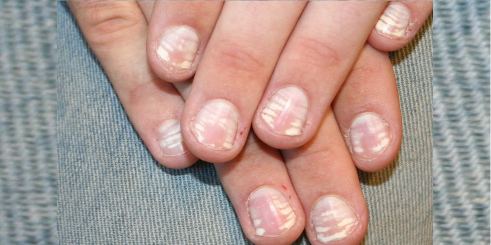 kuku ada tanda putih - OctaviotaroYang