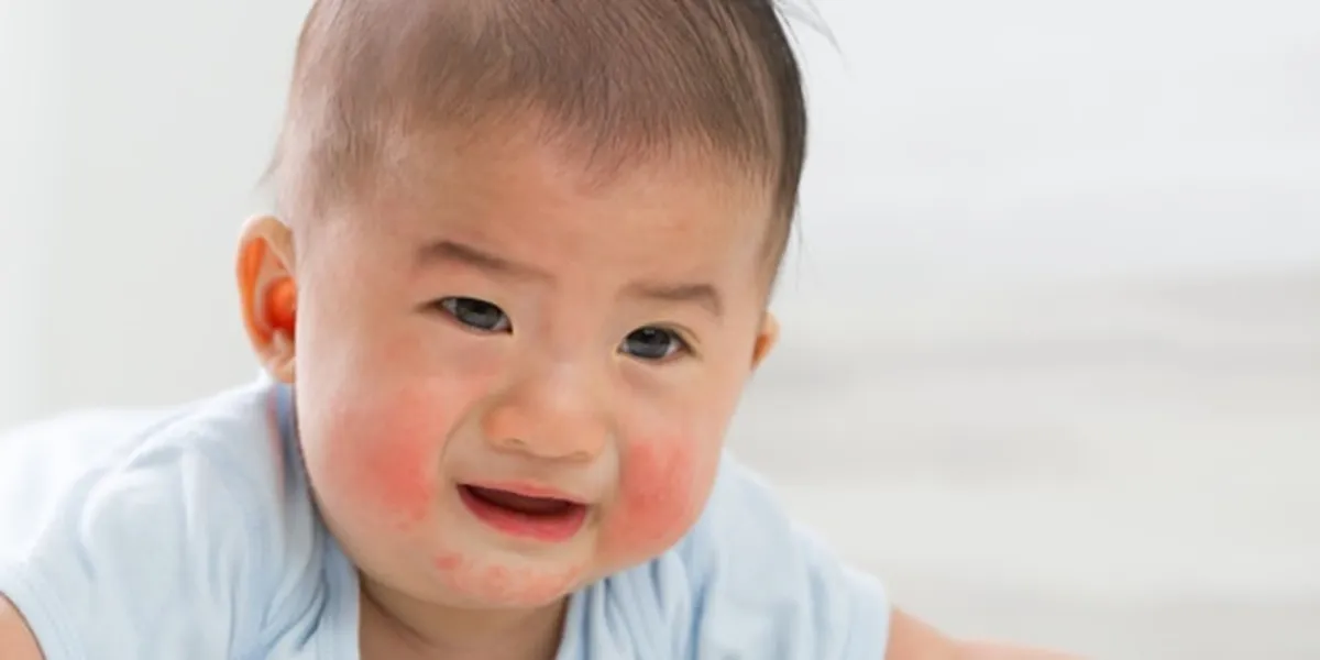 6 Gejala Alergi Susu Sapi Pada Anak, Orangtua Wajib Tahu - KapanLagi.com