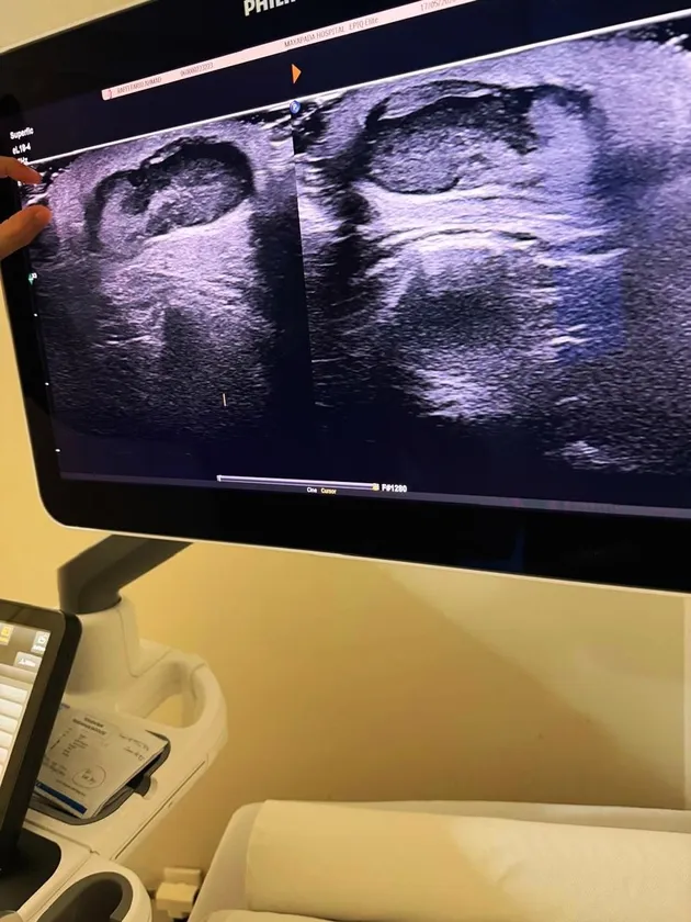 Raffi Ahmad Undergoes Surgery for Benign Tumor Lump on Shoulder ...