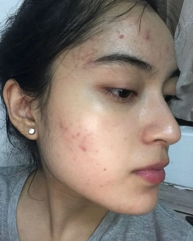 Portrait of Sarah Felicia Sharing Her Skin Journey: From Struggles ...